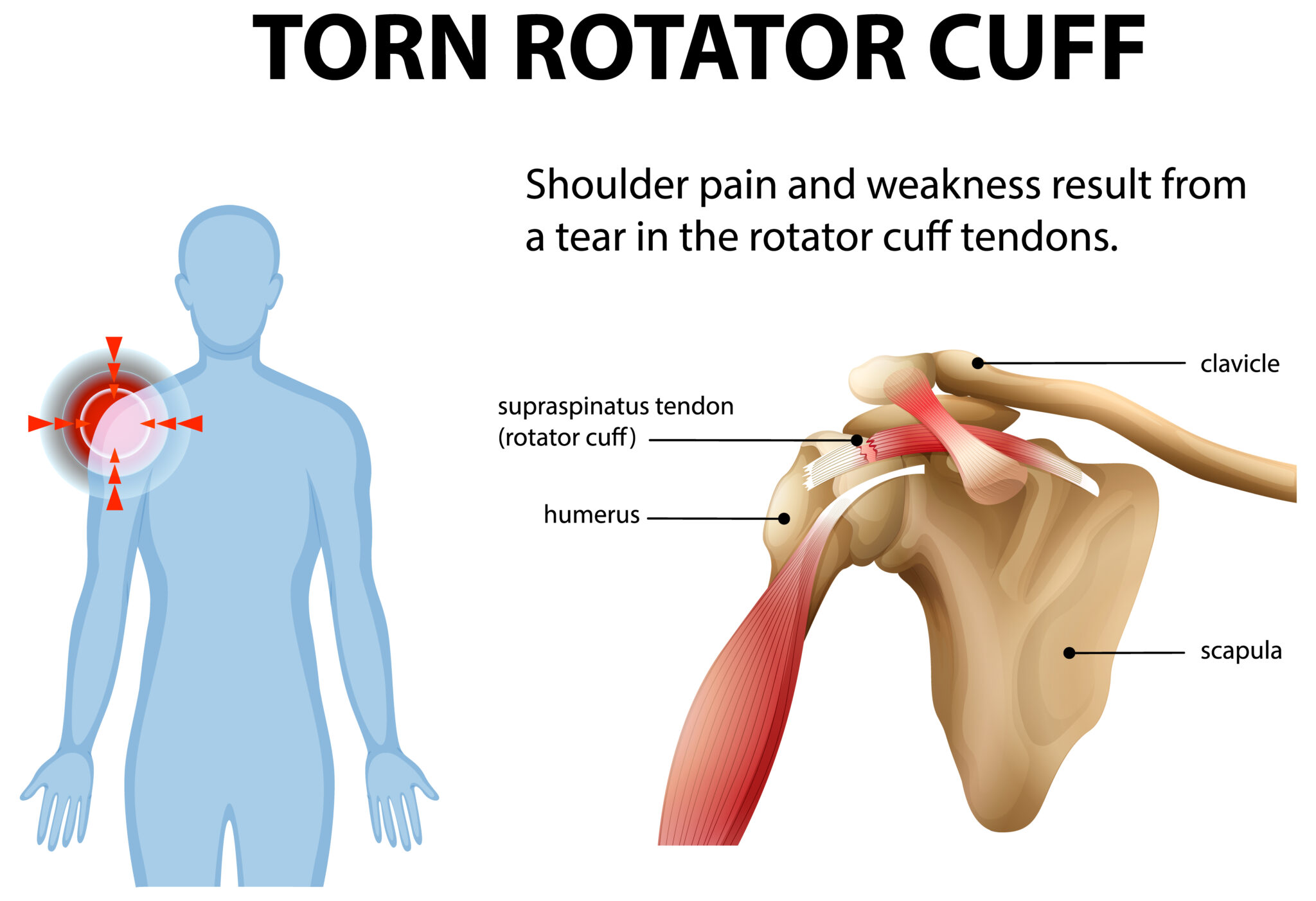 Shoulder Impingement Syndrome: Diagnosis and Treatment Options - Bear ...